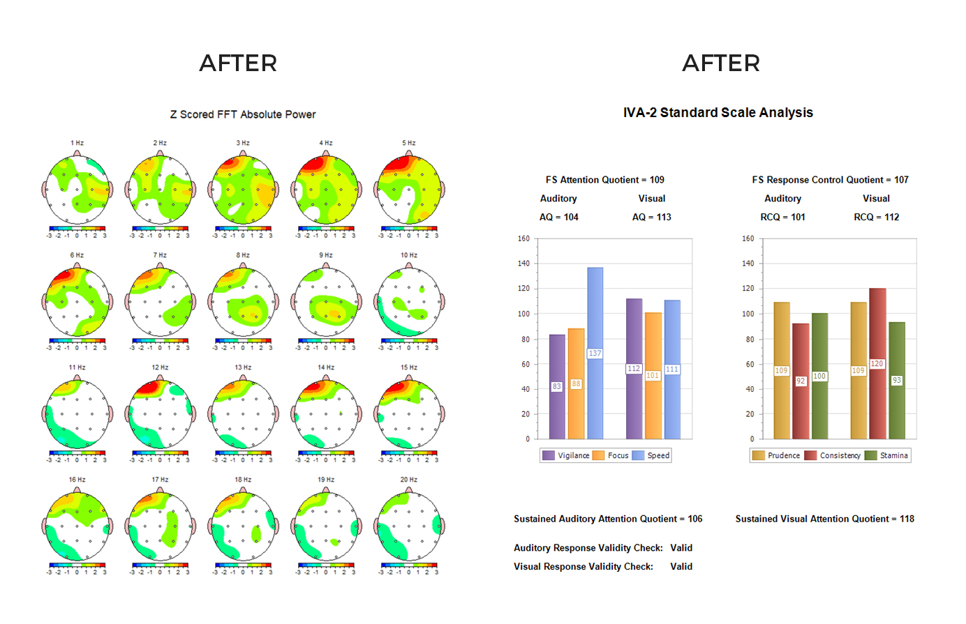Neurofeedback Patient #1 Neurofeedback Los Angeles | NeuroZone
